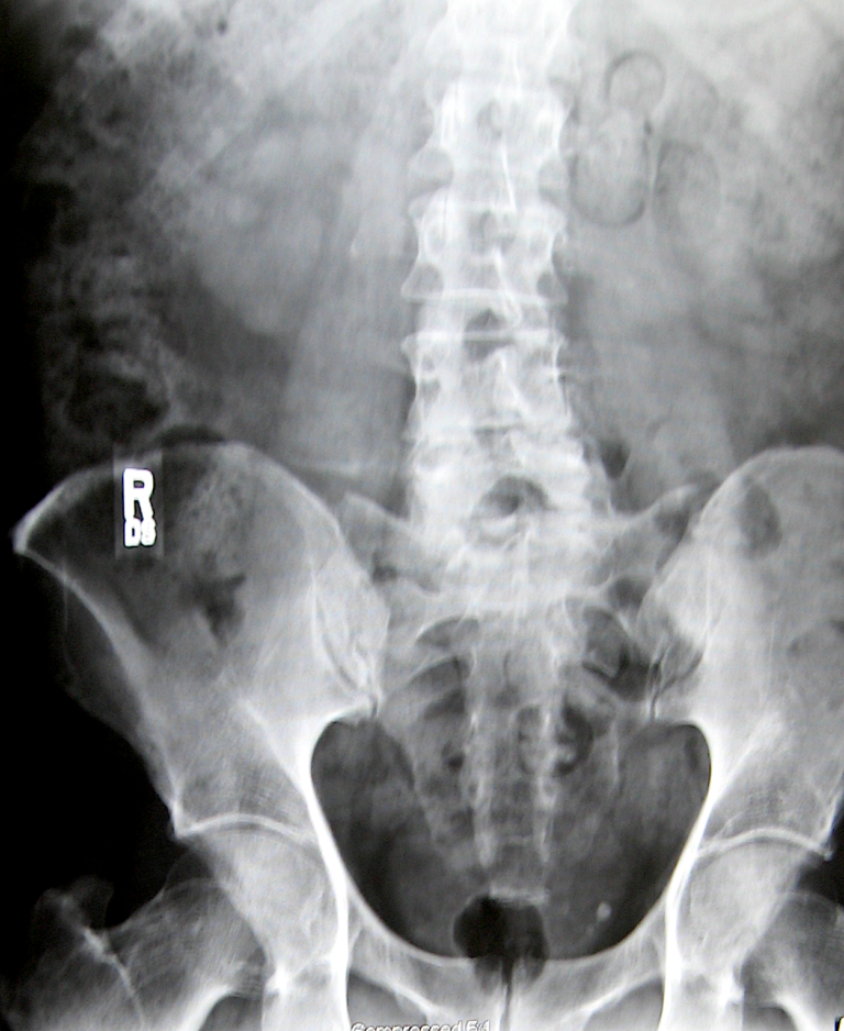 skr-lumbar-xray - Nomadic Research Labs